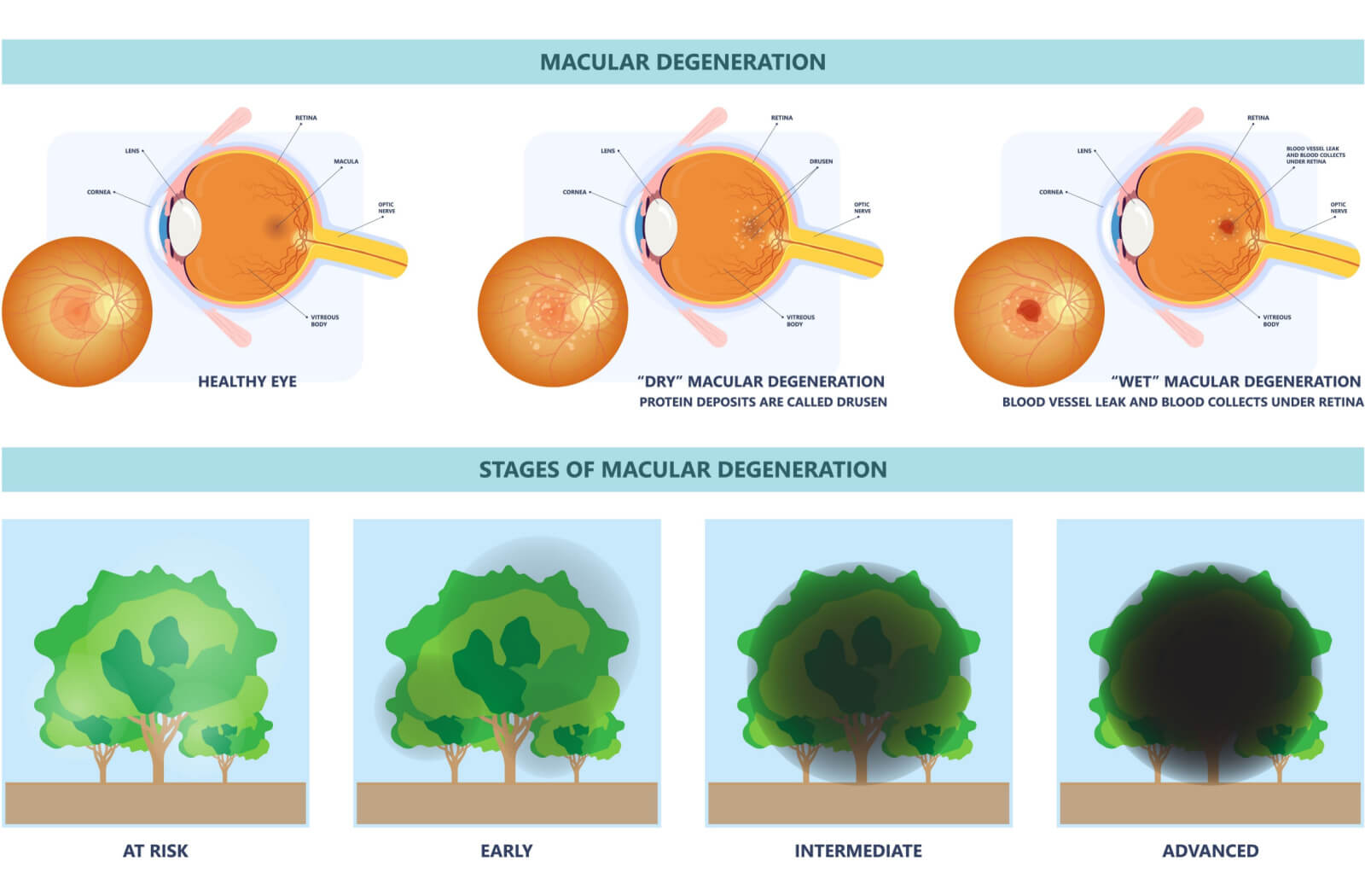 Is Macular Degeneration Hereditary? | Mississauga