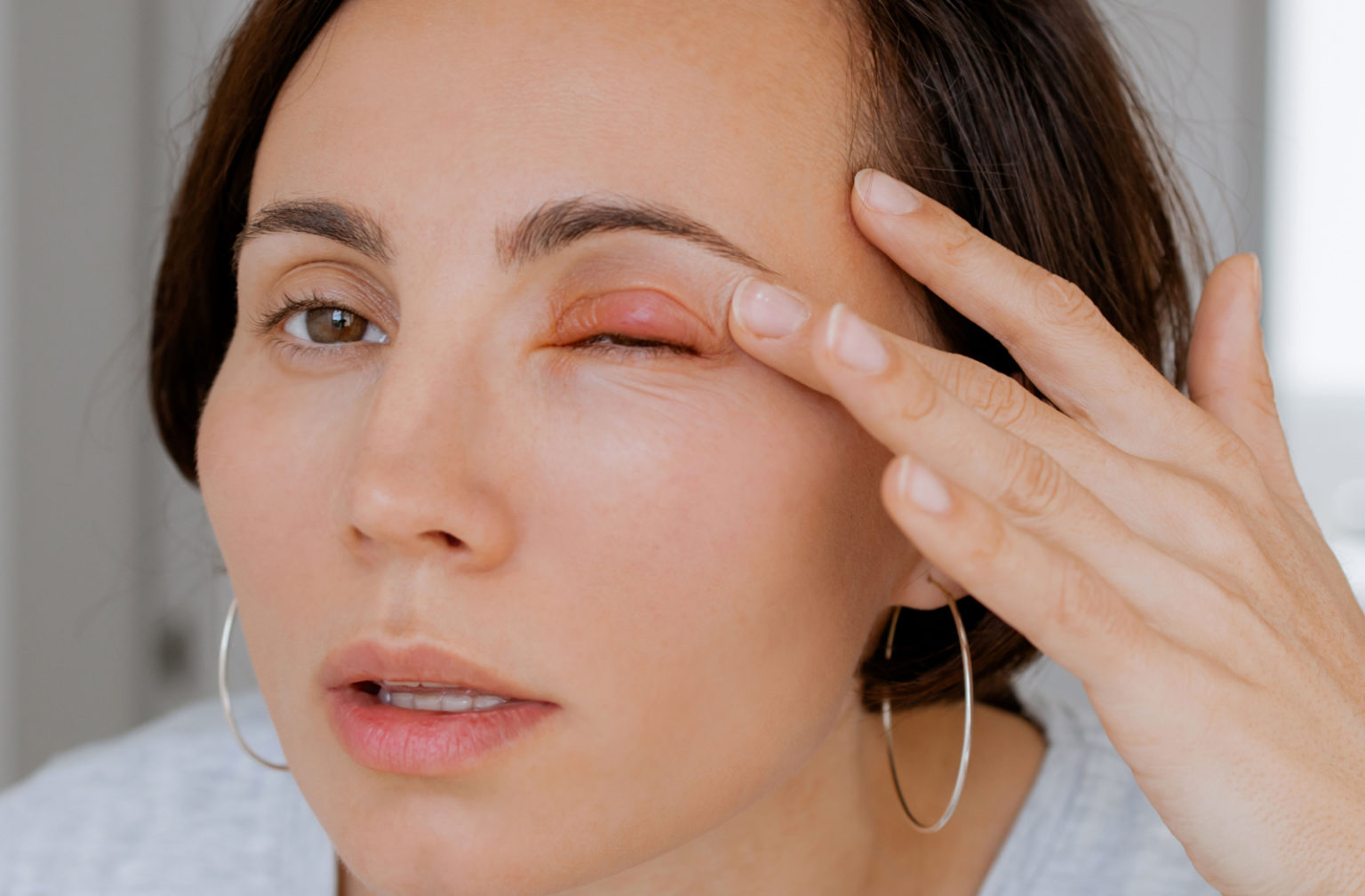 What Is the Actual Difference between Pink Eye and Styes?